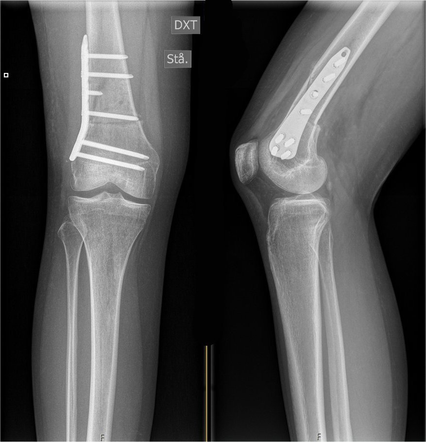 Inward pointing kneecaps - kissing knees